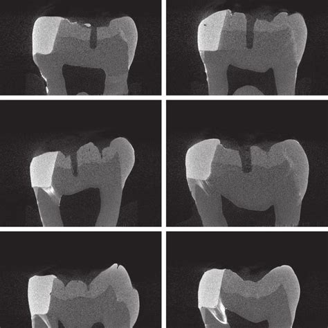 Pdf Evaluation Of Marginal Leakage Of Bulk Fill Flowable Composite