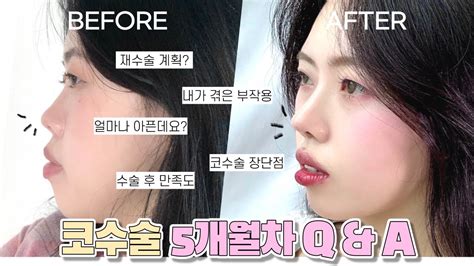 코수술 5개월 차가 말해주는 코 성형 Qanda🔥 부작용 재수술 할까🥲 가장 힘들었던 점 붓기and통증 기증늑vs자가늑
