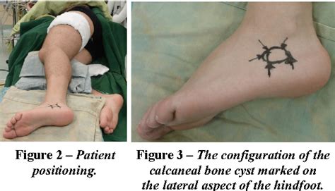 Figure 6 From Unicameral Bone Cyst Of The Calcaneus Minimally Invasive Endoscopic Surgical