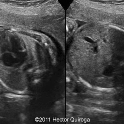 📃 Left Atrial Isomerism
