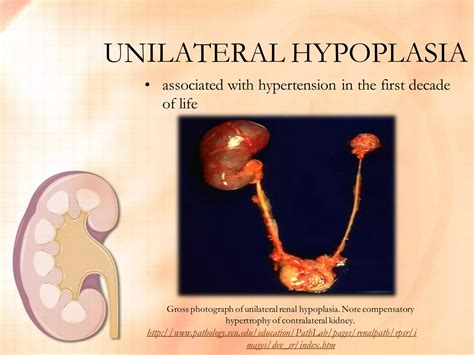 Renal Hypoplasia Final Output By Nica Valencia Pdf