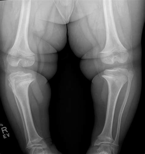 Achondroplasia X Ray Vs Normal