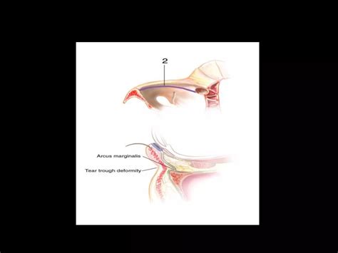 The Tear Trough Deformity Ppt