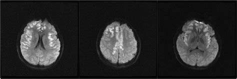 Late Onset Hyperornithinemia Hyperammonemia And Homocitrullinuria