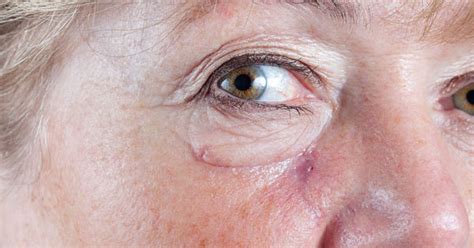 Anyajegy Eltávolítására Felkészülés Hegek Kezelése A Műtét Után