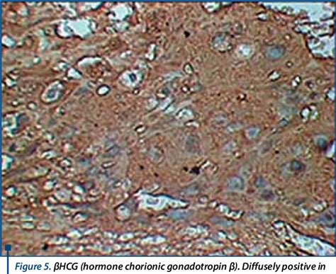 Figure 1 From Primary Choriocarcinoma Of The Cervix Mimicking A
