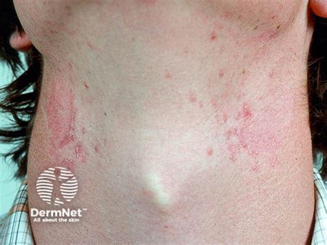 Elastosis Perforans Serpiginosa Images