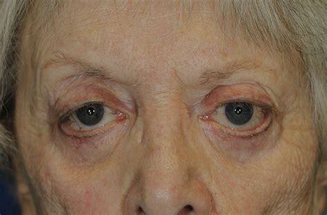 Droopy Lid Ectropion Repair With Lateral Tarsal Strip Seattle Facial
