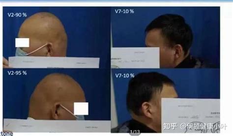 达必妥与可善挺这些生物制剂能够治疗斑秃吗？ 知乎