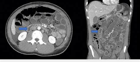 Small Bowel Thickening And Narrowing Of The Terminal Ileum Blue Arrows