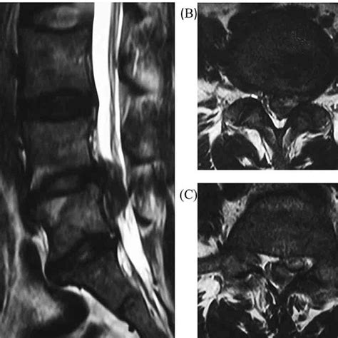 Preoperative Magnetic Resonance Imaging Sagittal A And Axial