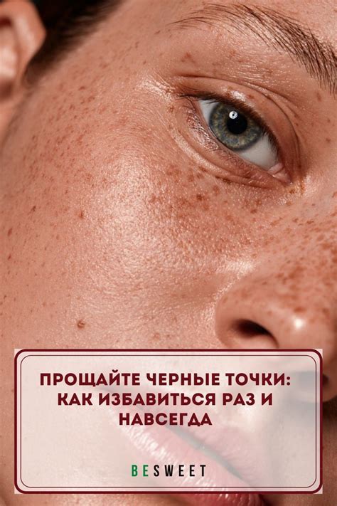 Прощайте черные точки: как избавиться раз и навсегда | Чистое лицо ...