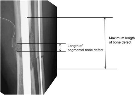 Segmental Bone Defect The Length Of The Bone Defect Was Calculated Download Scientific Diagram