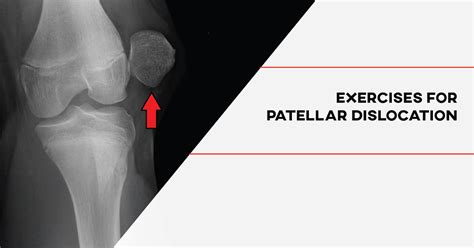 Exercises For Patellar Dislocation P Rehab