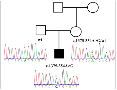 Identification Of Pola1 Gene Deep Intronic Mutation Confirms Diagnosis