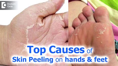 Dry Peeling Skin On Hands And Feet Store