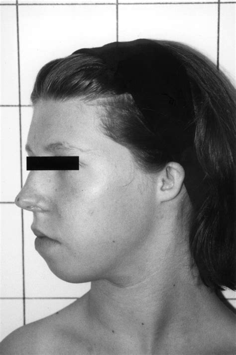 Макрогнатия