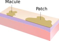 Nurs 161 Primary Skin Lesions Flashcards Quizlet