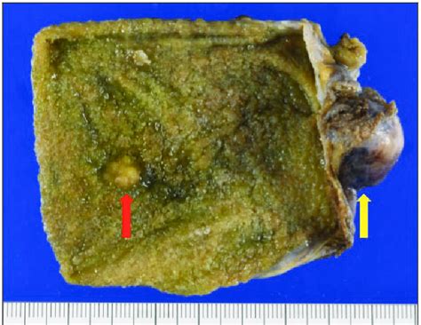The Resected Specimen Showed A 6 Mm Elevated Lesion Red Arrow And A