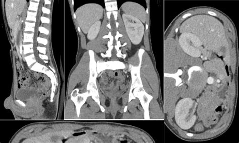Essential Information On Ct Scan For Abdomen And Pelvis