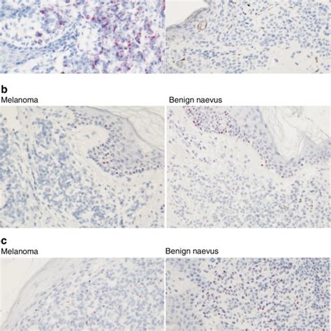 Mirna 21 A Mirna 205 B And Mirna 211 C Expression In Melanoma