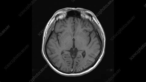 Healthy Brain Mri Scan Stock Image F0365759 Science Photo Library