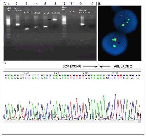 Full Text Atypical Bcr Abl Fusion Transcript E6a2 In Pediatric Acute Lymphoblastic Leukemia