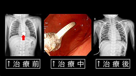 3歲娃誤吞硬幣 胃鏡夾出解危 自由健康網