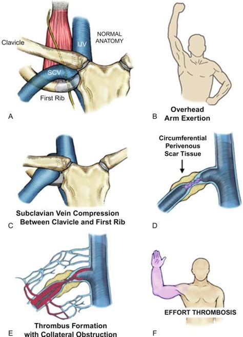 Vascular Compression Syndromes Clinical Tree