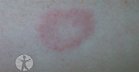 Dermnet® Granuloma Annulare Image