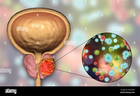 Conceptual Image For Viral Ethiology Of Prostate Cancer 3d