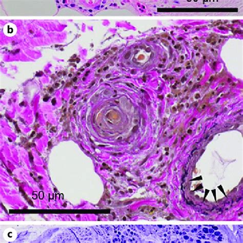 Pathologic Findings Of A Sural Nerve Biopsy Specimen Transverse