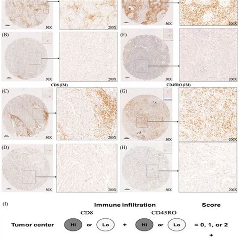 Tumor Infiltrating Lymphocytes Were Stained With Cd8 And Cd45ro