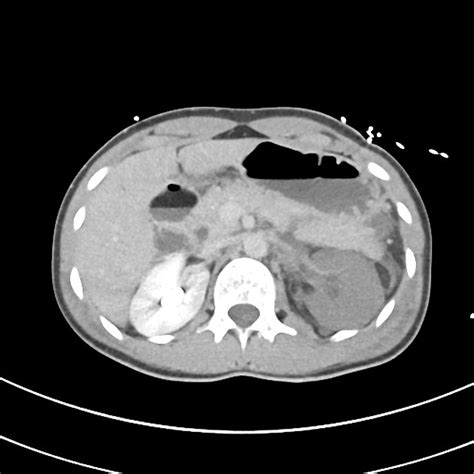 Pancreatic Trauma With Pancreatic Transection Pacs
