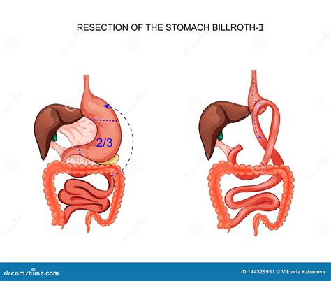 Billroth Surgery