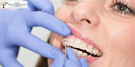 What Is Covered In Bite Alignment Miami Orthodontist Group Blog