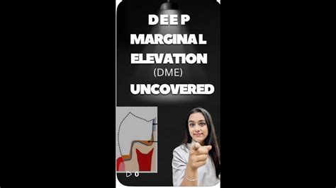 Deep Marginal Elevation Youtube