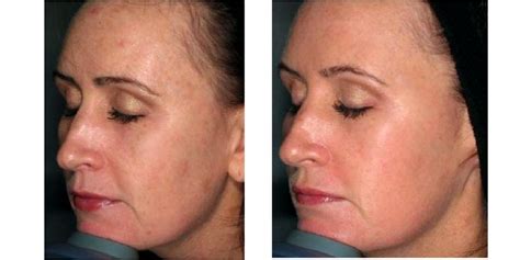 Can Laser Treatment Cause Cancer Proskin Clinics
