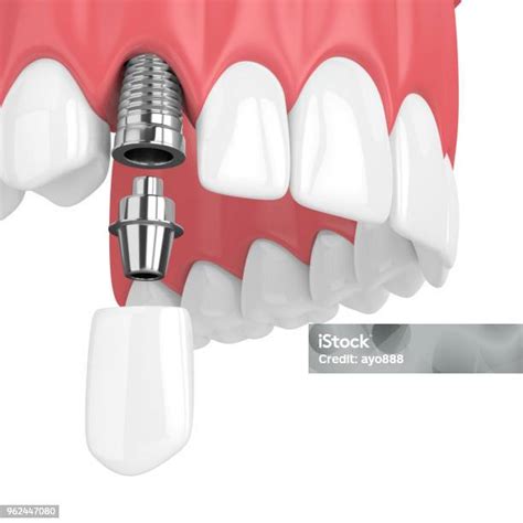 치과 개 임 플 란 트와 위 턱의 3 차원 렌더링 임플란트에 대한 스톡 사진 및 기타 이미지 임플란트 치아 건강 치아 임플란트 Istock