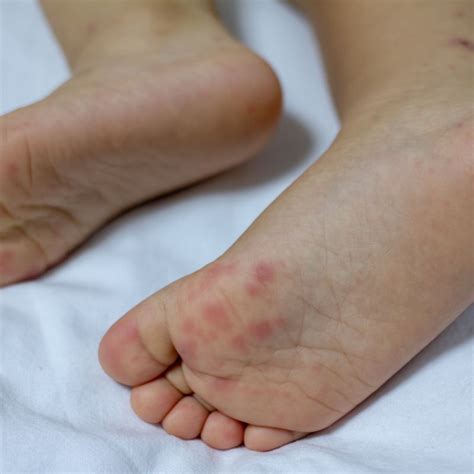 Voet Eczeem Oorzaak En Onze Tips Boots Nederland