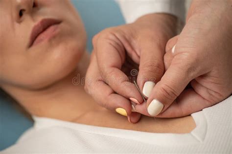 Acupuncture Treatment For Managing Anxiety Stock Image Image Of