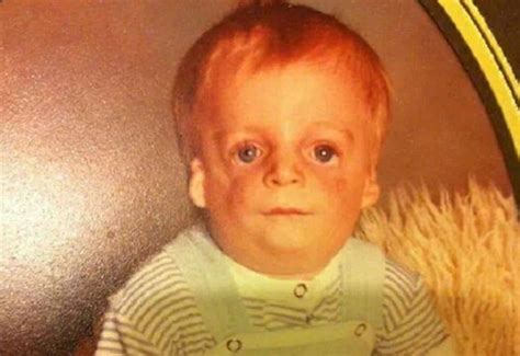 Su Madre Lo Abandonó Al Nacer Por Este ‘defecto En Su Rostro Pero