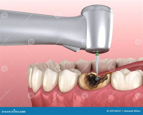Caries Removing Process Medically Accurate Tooth Illustration Royalty