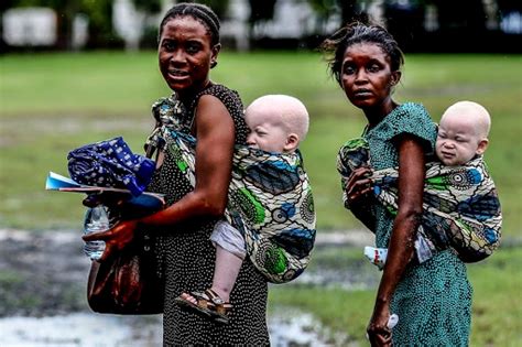 Ser Albino En África Un Peligro De Muerte Piedra Papel Y Tijera