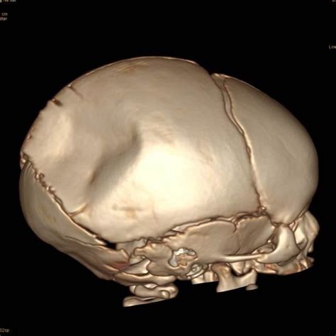 Non Contrast Ct Head In Soft Tissue Algorithm Showing The Bony Download Scientific Diagram