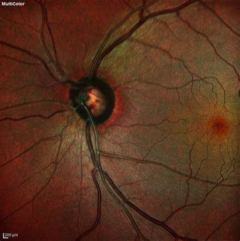 Glaucoma Detection Using Retinal Nerve Fiber Layer Optical Texture