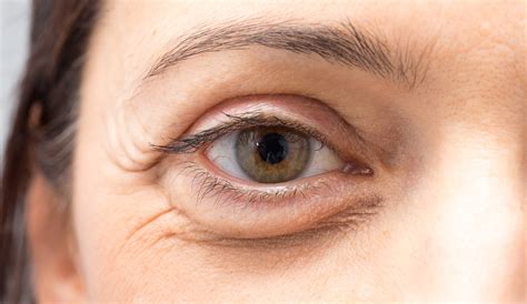 Eye Bag Treatment Eden Skin Clinic Wimbledon Kensington