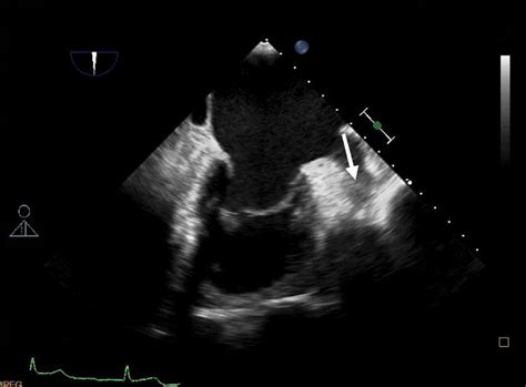 Laa Thrombus Arrow In 2d Transesophageal Echocardiography Tee