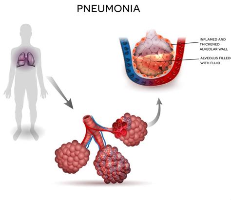 Chlamydia Pneumoniae Symptoms Types Diagnosis Treatment