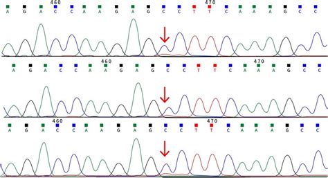 Direct Sequencing Of The Mt Tw Revealed The M 5541c T Mutation Download Scientific Diagram